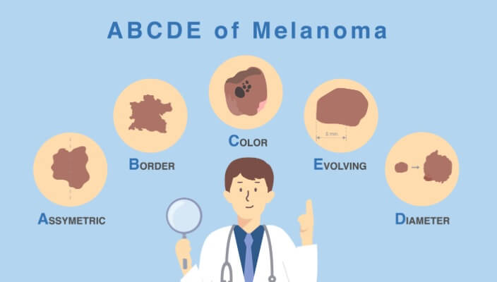 ABCDEs of Melanoma | Center for Surgical Dermatology